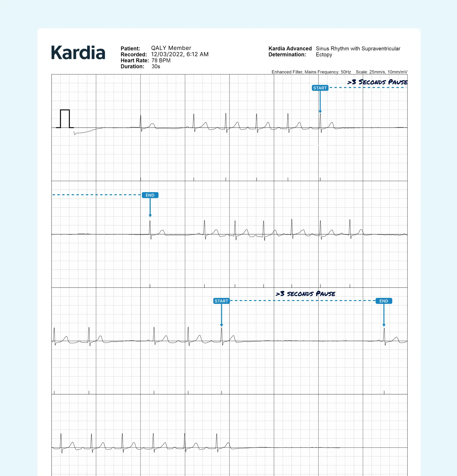 Wenckebach Vs. Sinus Pause >3 Seconds on Your Watch ECG | Qaly